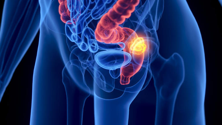 A new gene-editing treatment just drove back advanced stomach and colon ...