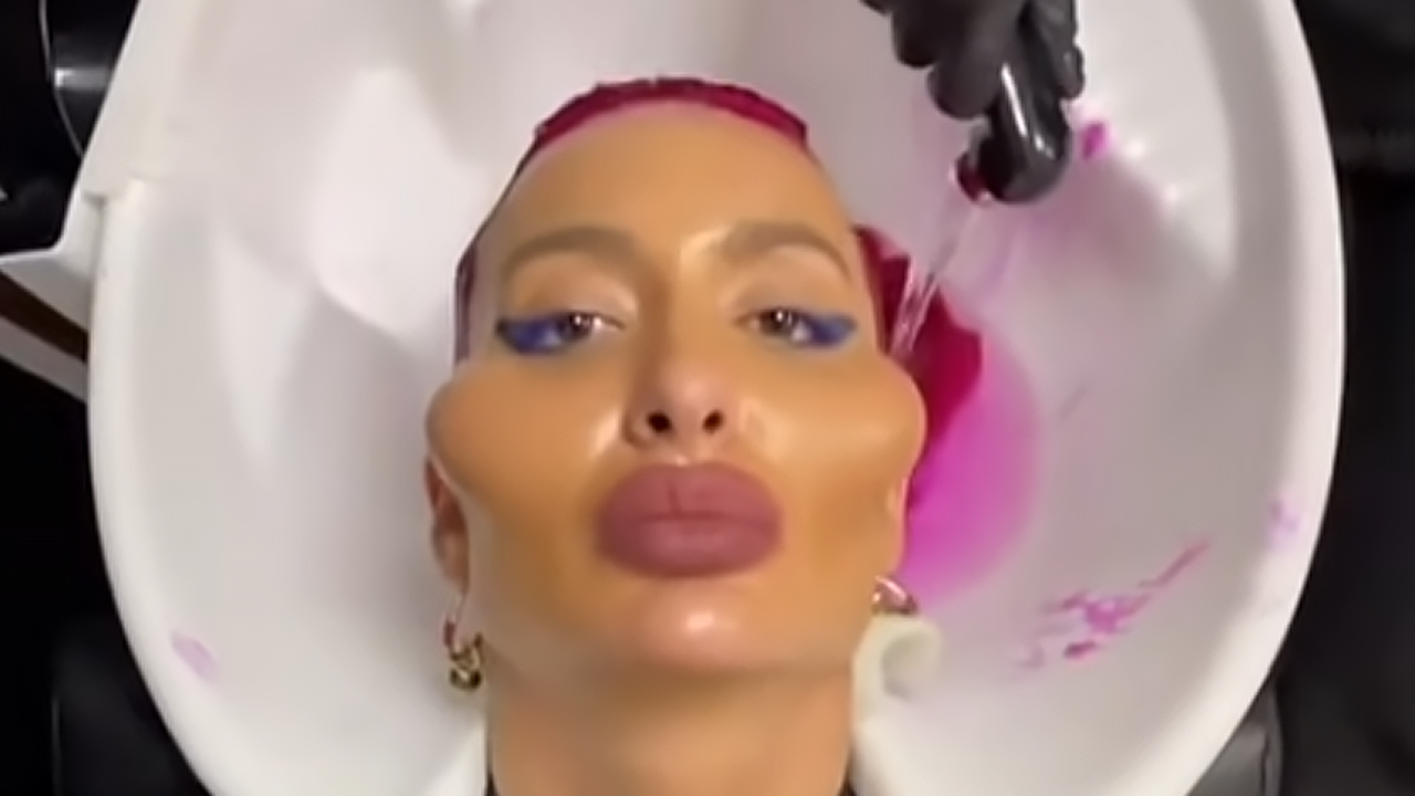 Plastic surgeon reacts: cheek filler or implants?