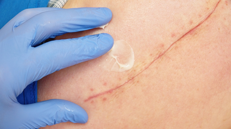 Things that really work to reduce the appearance of scars