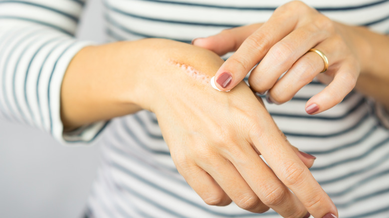 Things that really work to reduce the appearance of scars