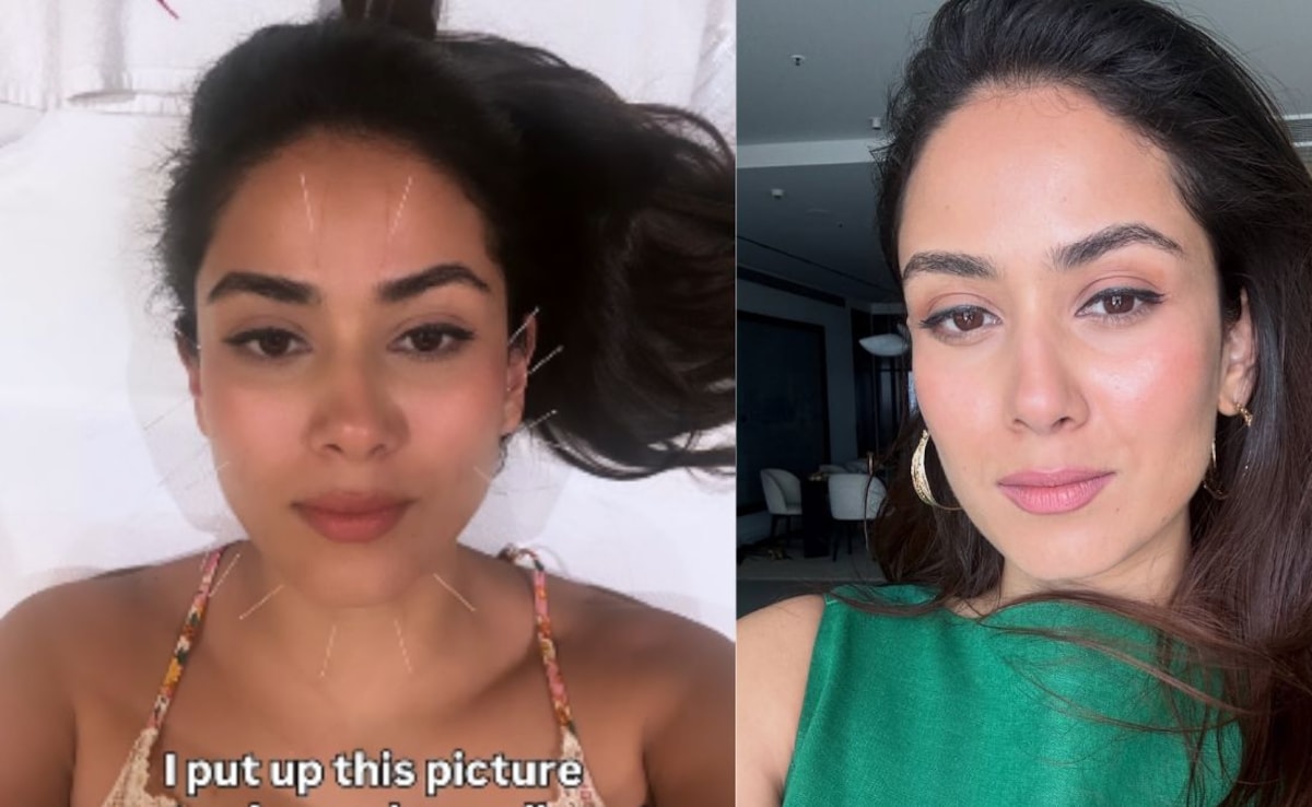 Mira Kapoor swears by cosmetic acupuncture, shares benefits: 'Face ...