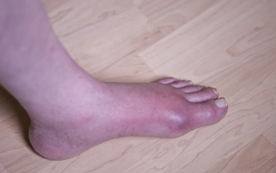 Gout-friendly eating made simple and satisfying