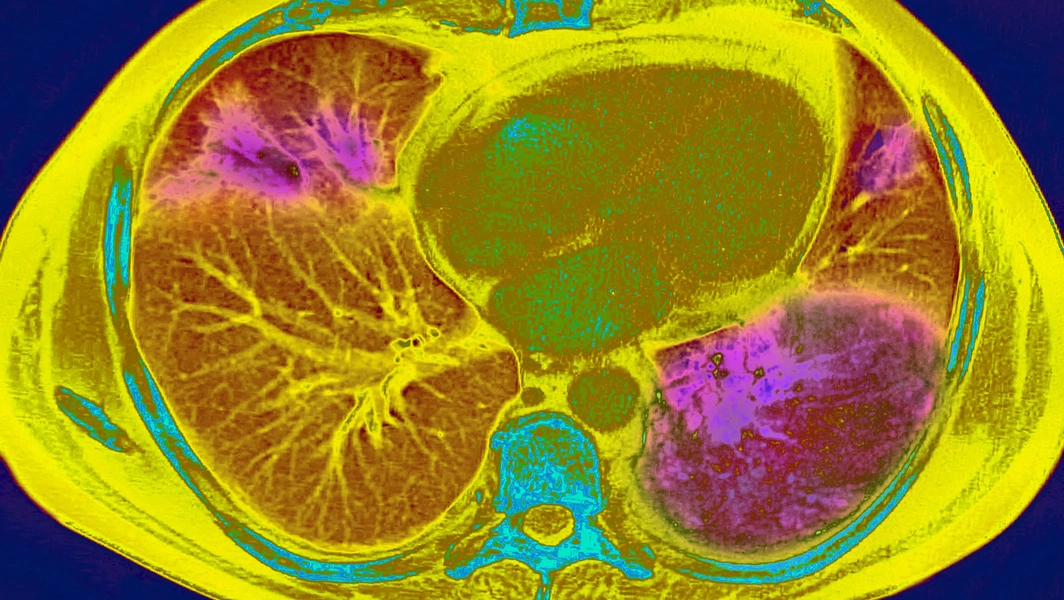Doctors warn sepsis is deadly, elusive and often misread