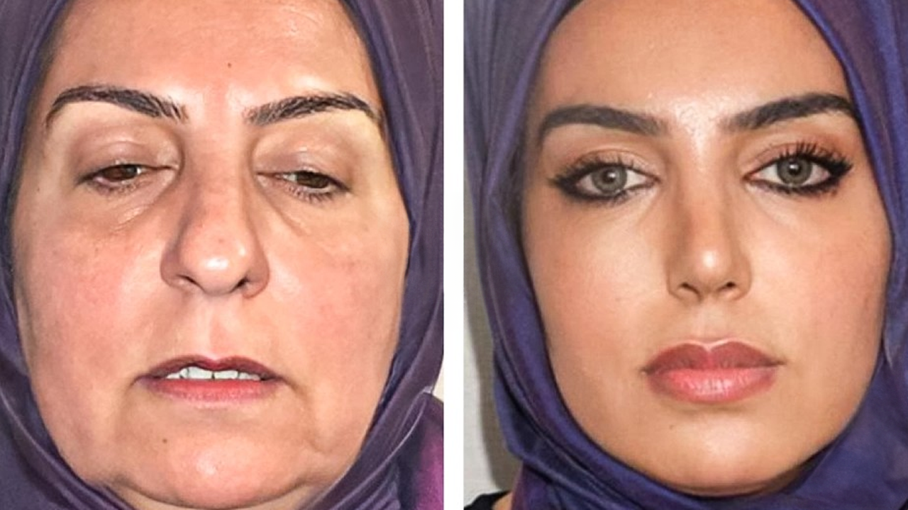 Extreme cosmetic surgery results from Turkey analyzed