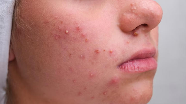 Acne vs pimples: What is the difference and how are they treated?