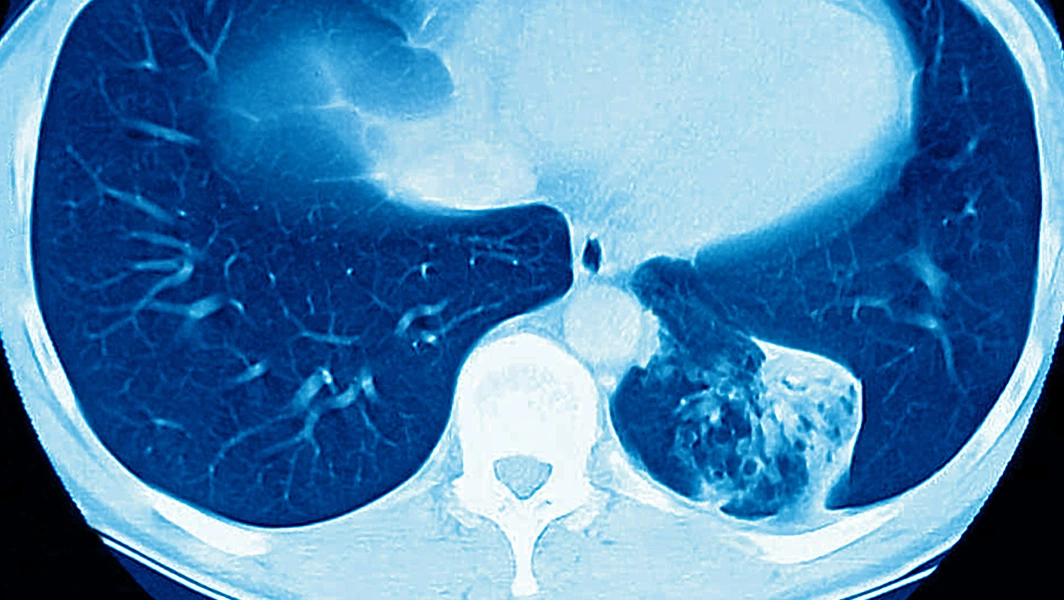 Mobile NHS lung scans detect over 10,000 early cases