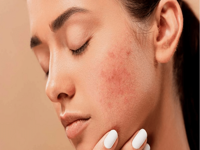 Skin care alert: These foods may trigger acne and pimples, experts ...