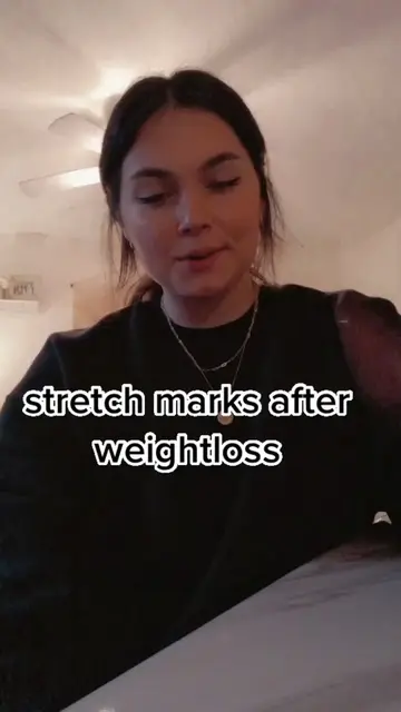 How I faded my stretch marks after weight loss