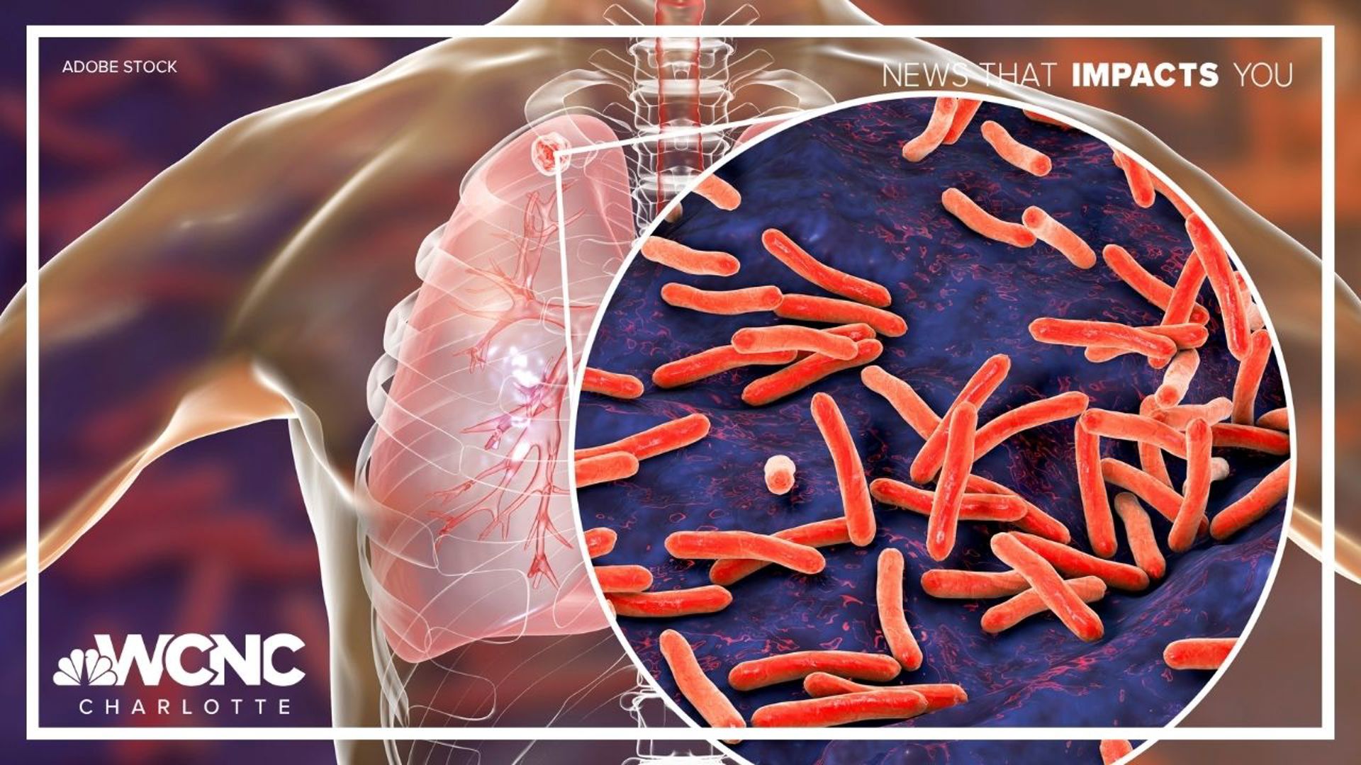 Health officials investigate possible tuberculosis exposure at middle ...