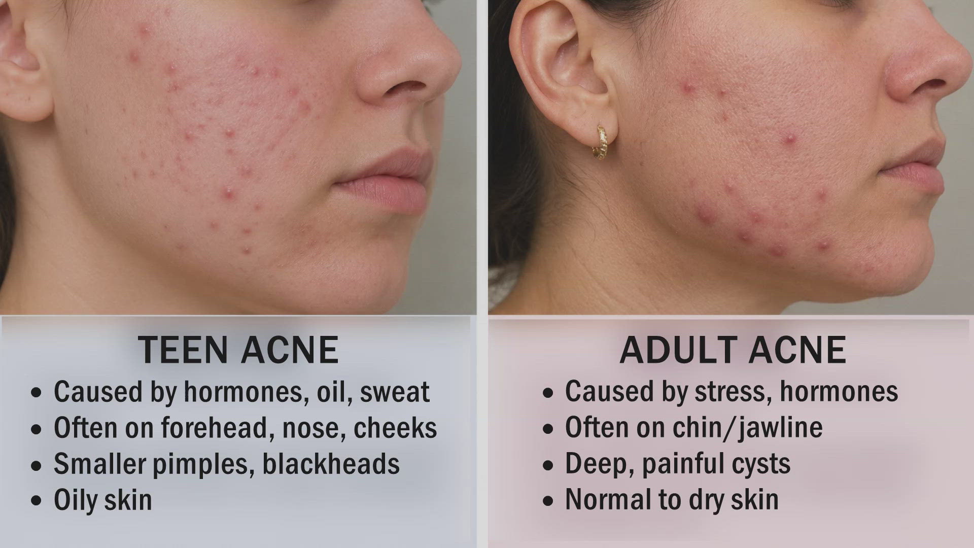Skincare expert talks about effective acne treatments