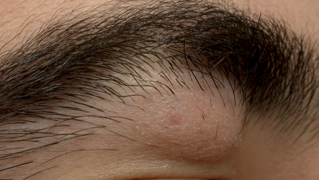 Skin tags decoded for your peace of mind