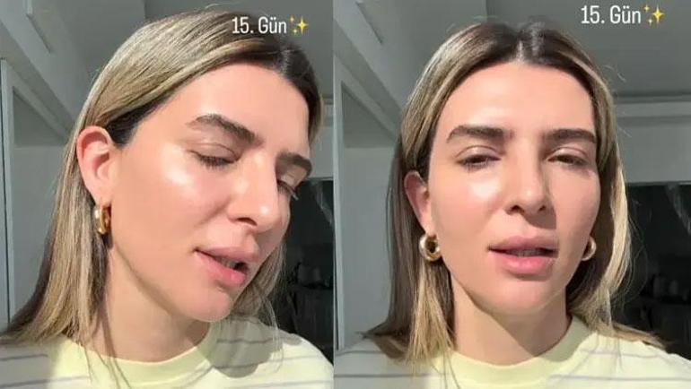 Survivor Merve Aydın’ın değişimi şaşırttı! Yüzüne yaptırdığı işlemi tek ...