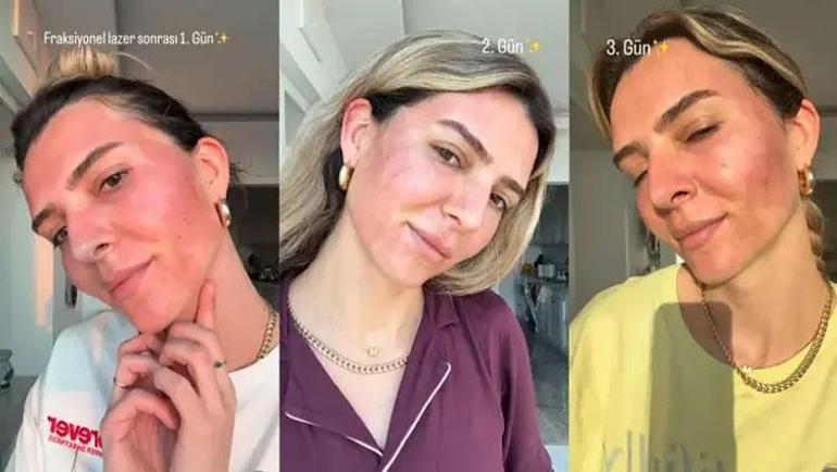 Survivor Merve Aydın’ın değişimi şaşırttı! Yüzüne yaptırdığı işlemi tek ...