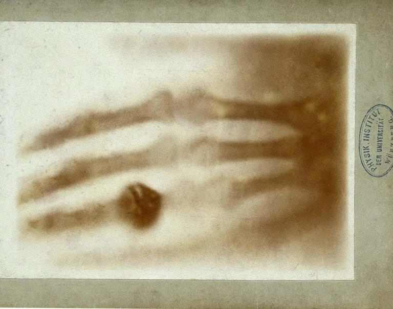 In 1895, Wilhelm Rontgen noticed a glowing screen in a dark lab, tested ...