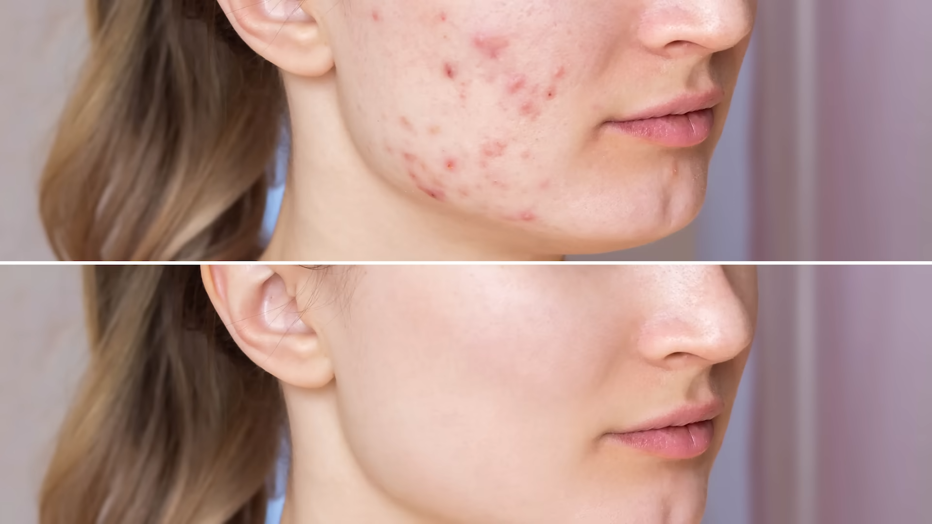 Plastic surgeon explains phenol peel procedures