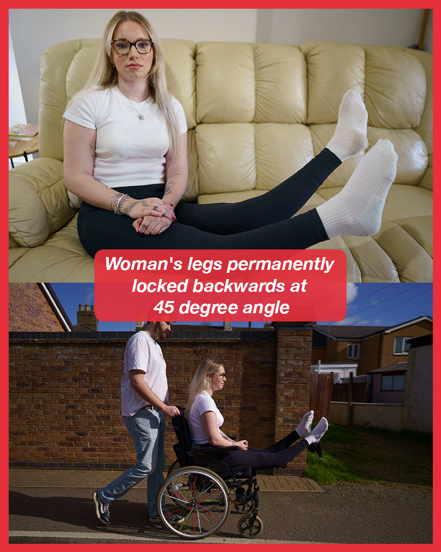 Woman’s legs permanently locked backwards at 45 degree angle