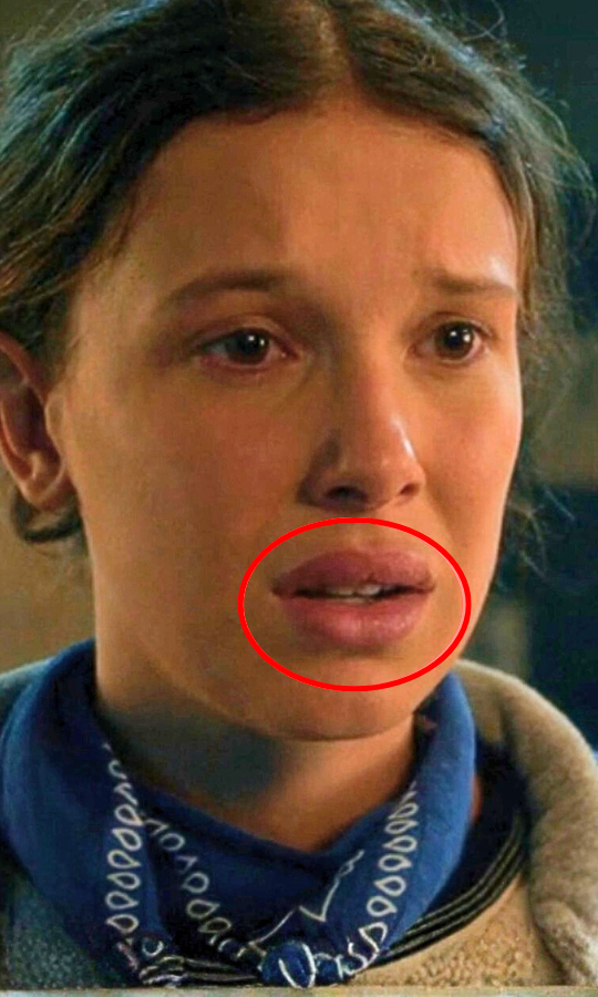 Millie said this about lip filler