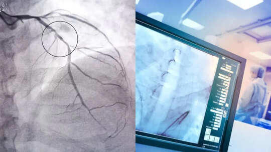 Angiography vs angioplasty: The heart procedure mix-up doctors want ...