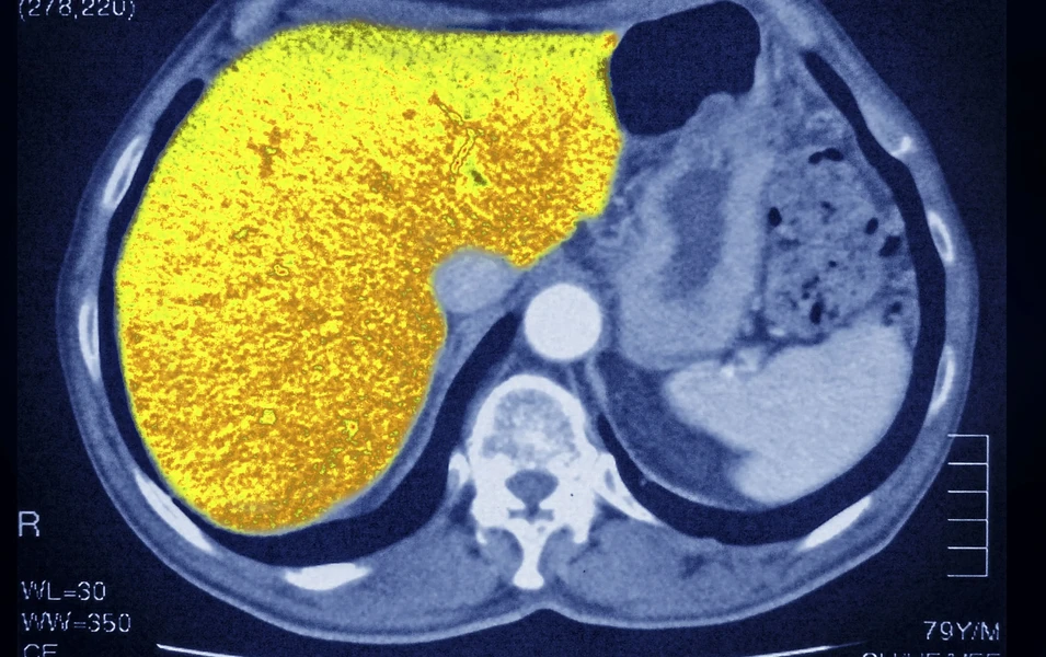 Global review finds healthy diet linked to lower liver disease risk