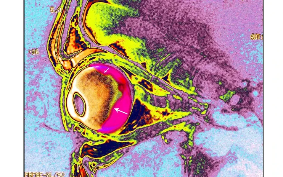 What your eye floaters might be telling you