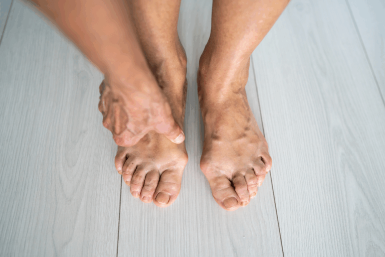 Why are your feet and ankles swollen at the end of the day? A Yale ...