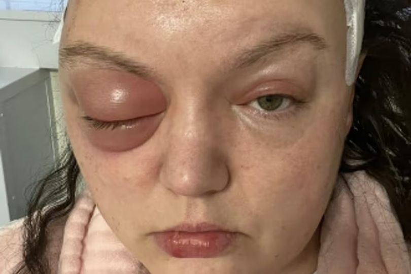 Scottish woman with bulging eye 'from 20 years of contraceptive jab' to ...