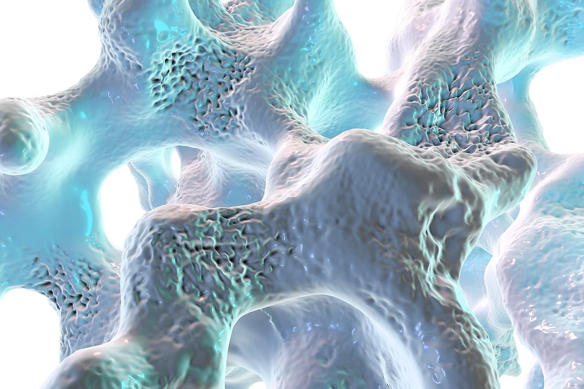 Femoral BMD, osteoporosis linked to all-cause mortality postmenopause