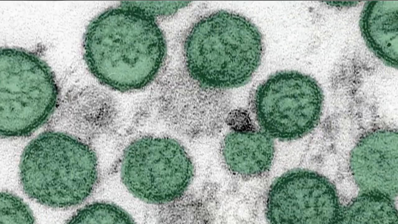 Suspected hantavirus case in Illinois tests negative, health officials say