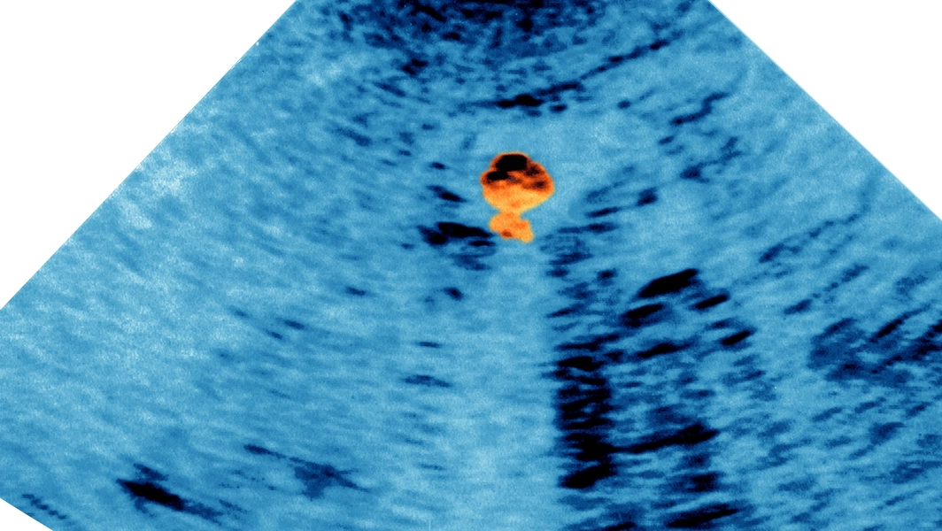 Woman’s two-year misdiagnosis nearly led to fatal gallbladder rupture