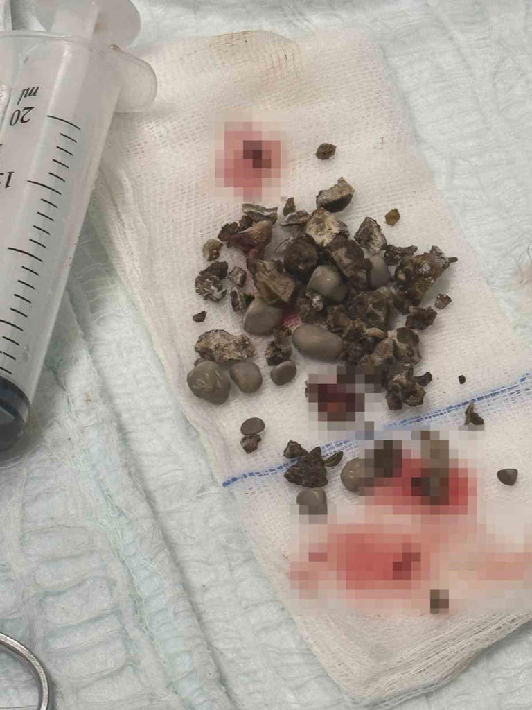 Siirt’te böbrek taşı hastasına 'nokta atışı' müdahale