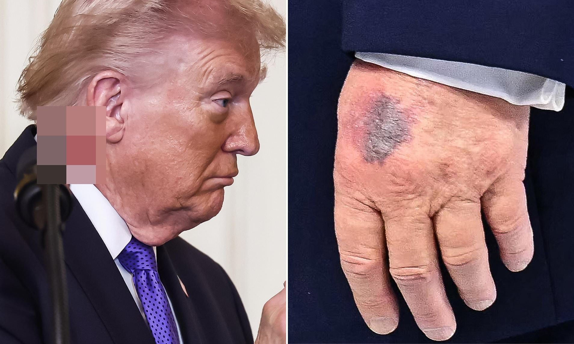 Trump in fresh health storm as he returns to hospital: Mental sharpness ...