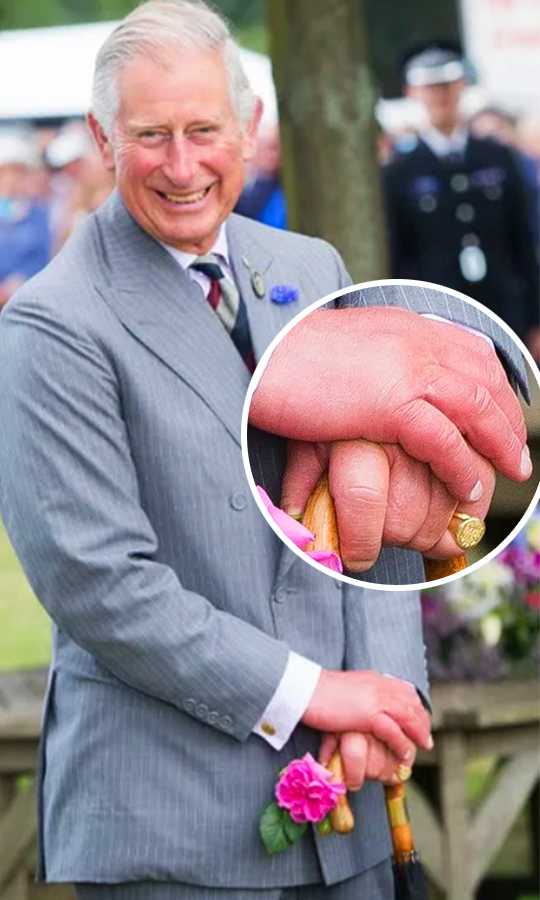 King Charles’ fingers spark concern