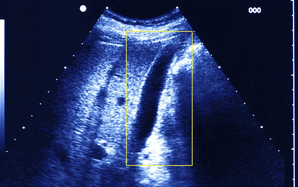 Woman’s two-year misdiagnosis nearly led to fatal gallbladder rupture