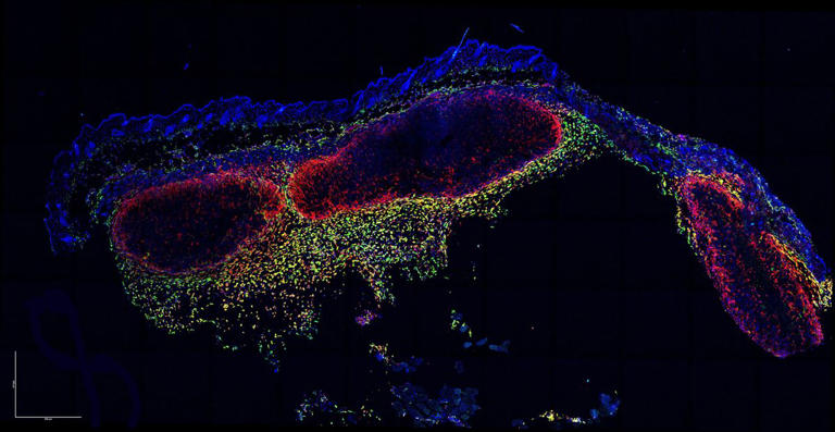 Macrophage vs. melanoma: Watch an epic immune battle play out in first ...