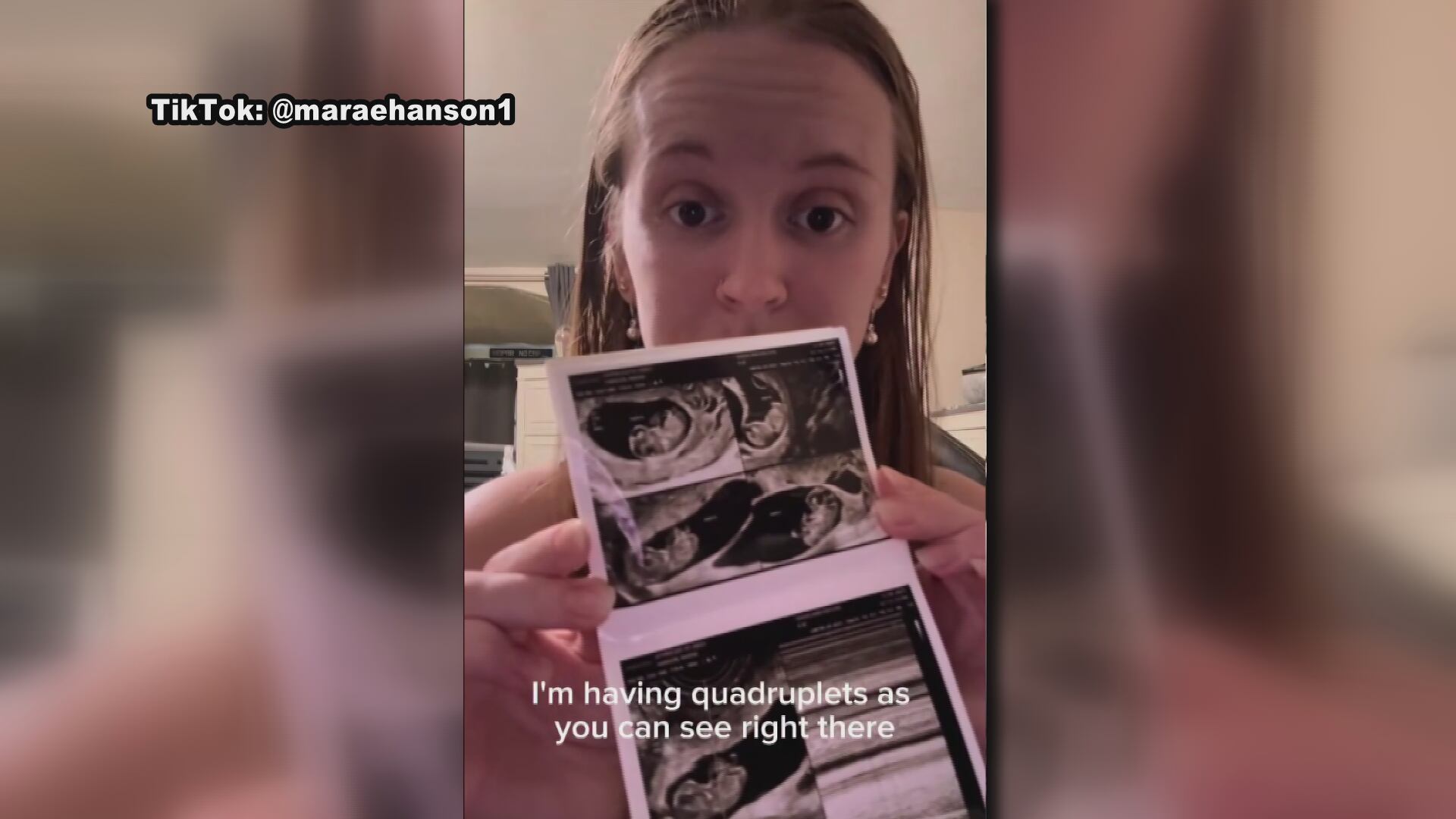 Sioux City woman goes viral on social media for rare quadruplet pregnancy