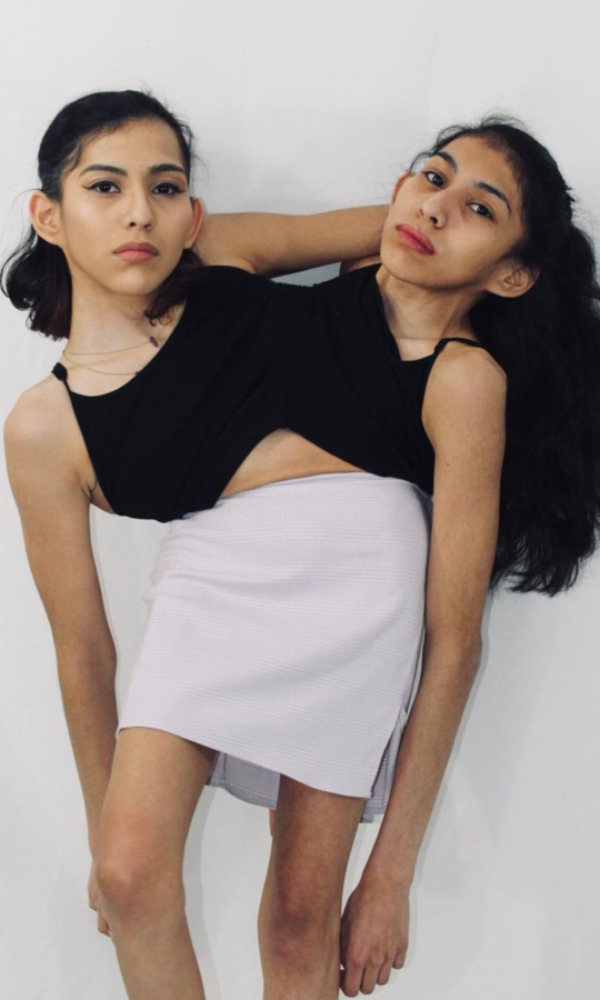 Conjoined twin has a boyfriend ️