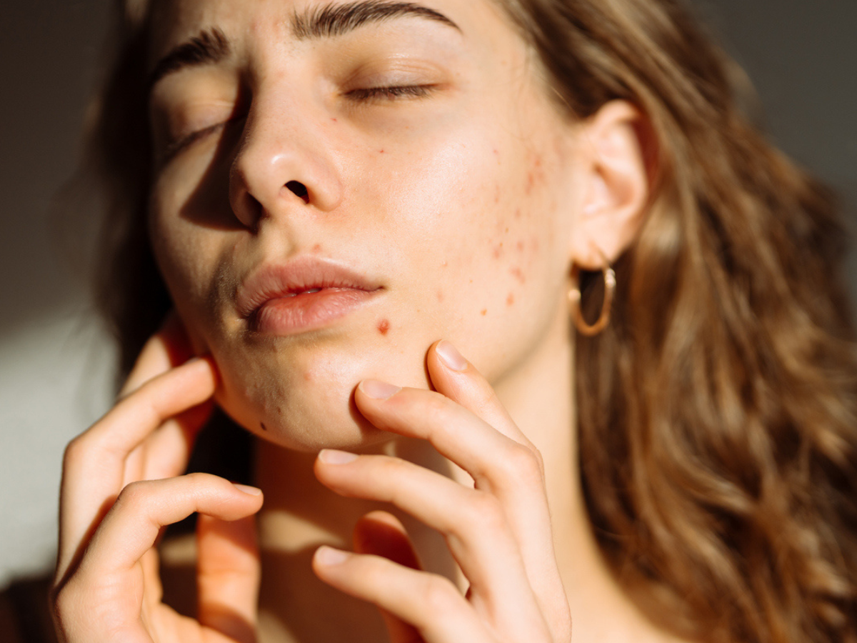 Still getting acne? These 7 simple fixes might be the real solution