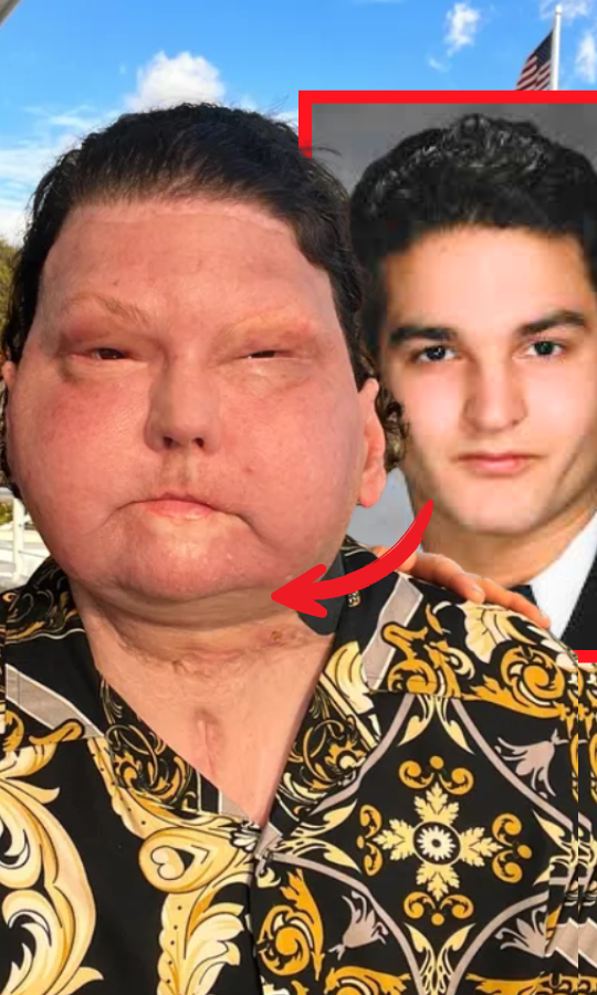 Teen receives face transplant from 46 year old