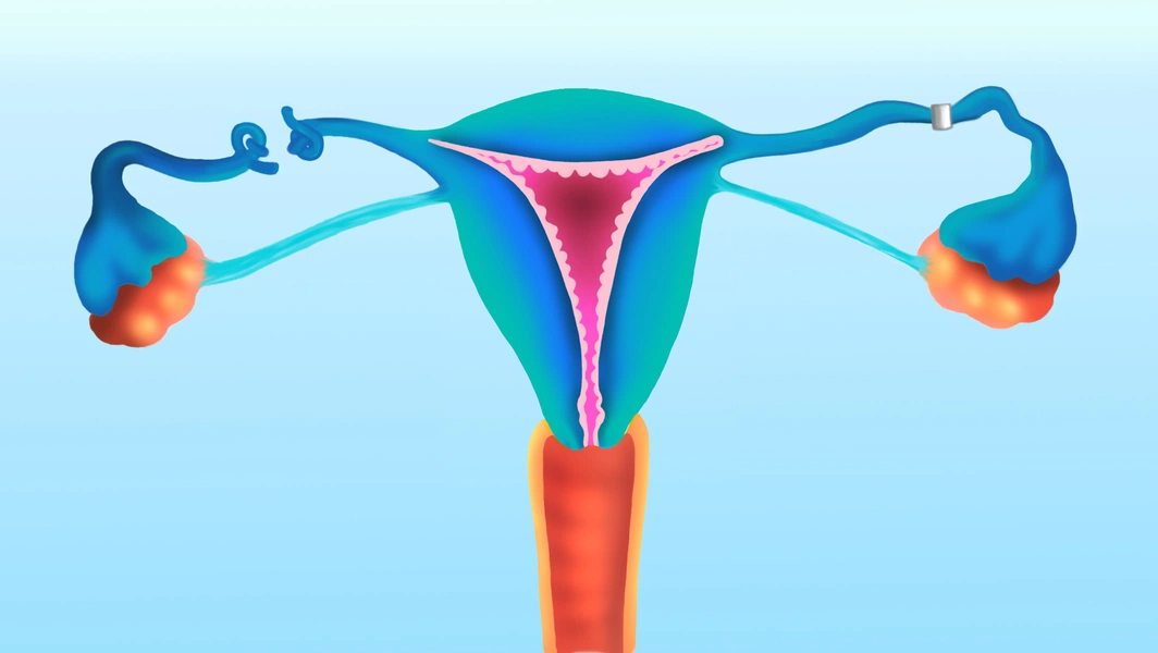 Fallopian tube removal gains attention for cancer prevention