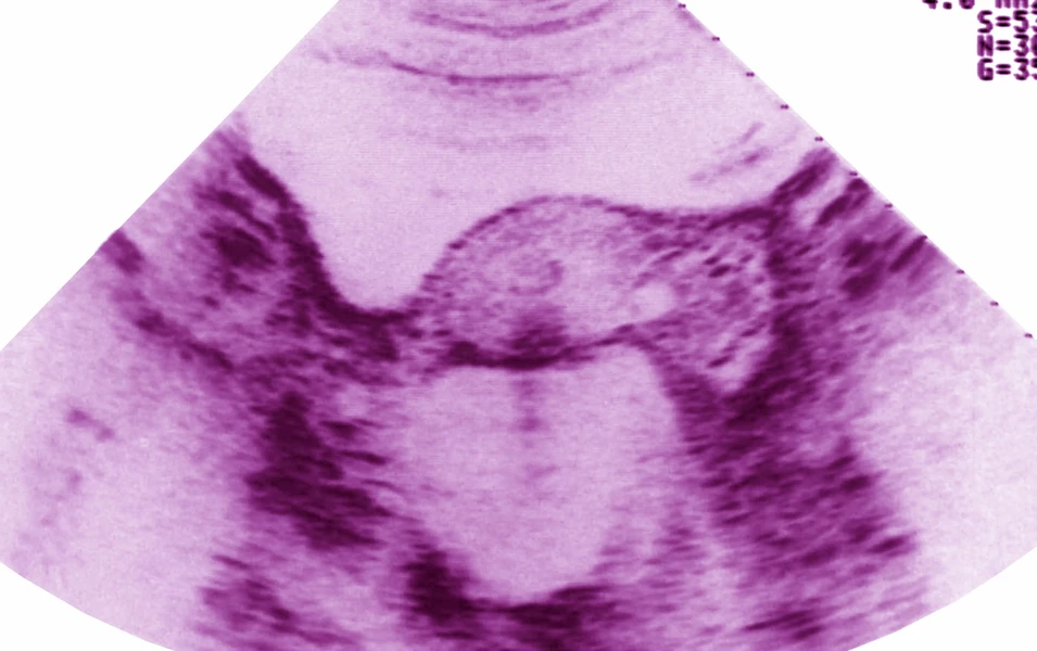Fallopian tube removal gains attention for cancer prevention