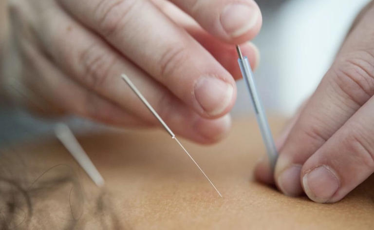 Mira Kapoor claims facial acupuncture tightens skin, what a Delhi ...
