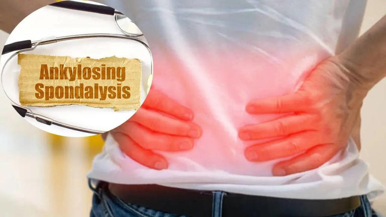 Ankylosing spondylitis can silently freeze your spine - here’s how to ...