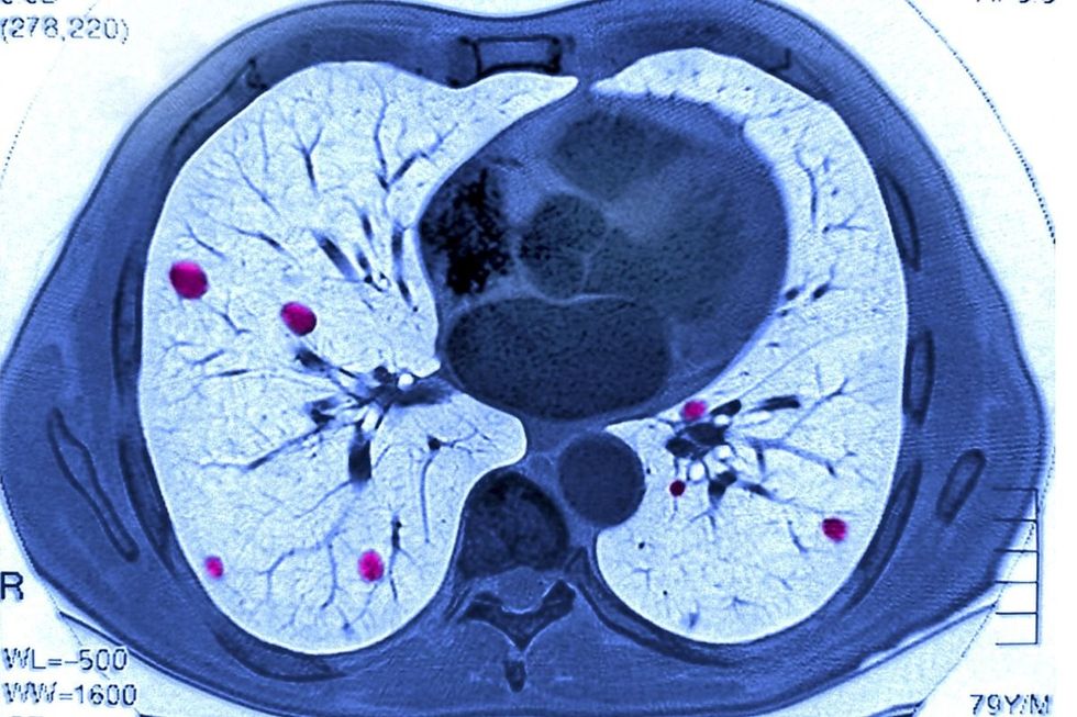 NHS mobile scanning units detect lung cancer in more than 10,000 ...