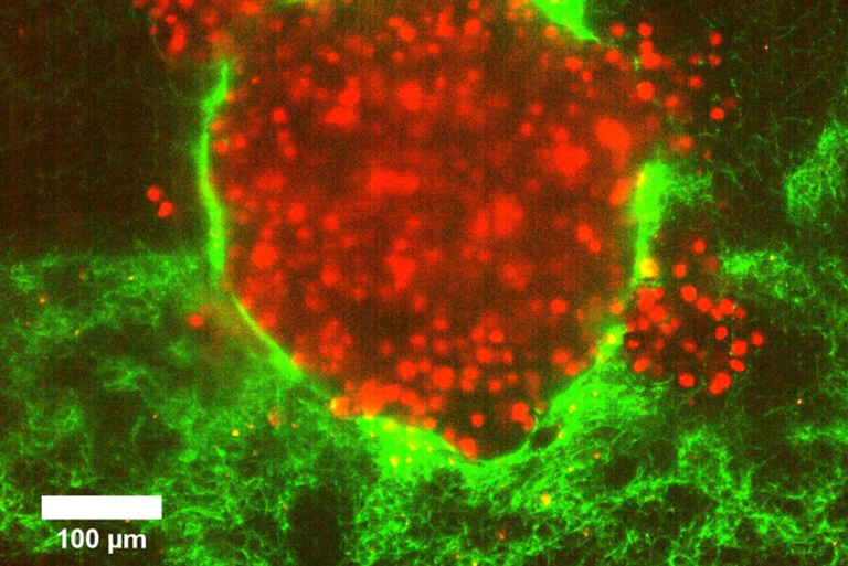 Studies reveal why some cancers are so much more dangerous than others
