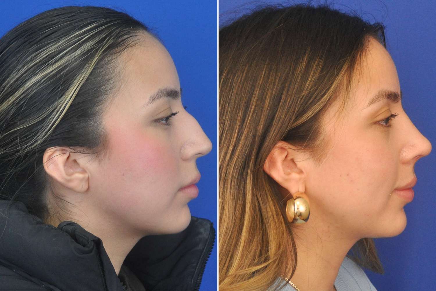 She wanted to get a nose job for 15 years. She was nearly speechless ...