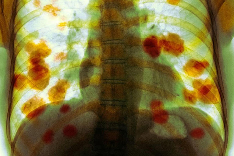 'Zombie' cell urine test could catch lung cancer months before symptoms ...