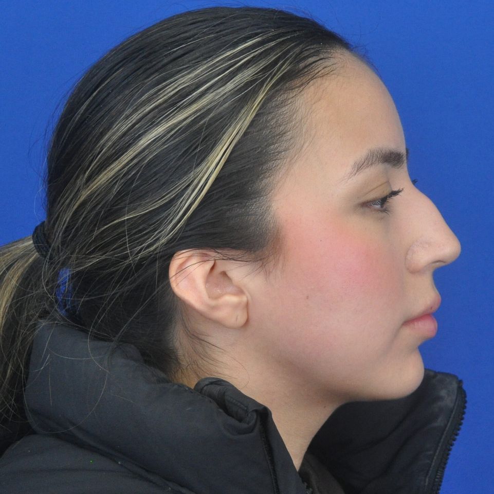 She wanted to get a nose job for 15 years. She was nearly speechless ...