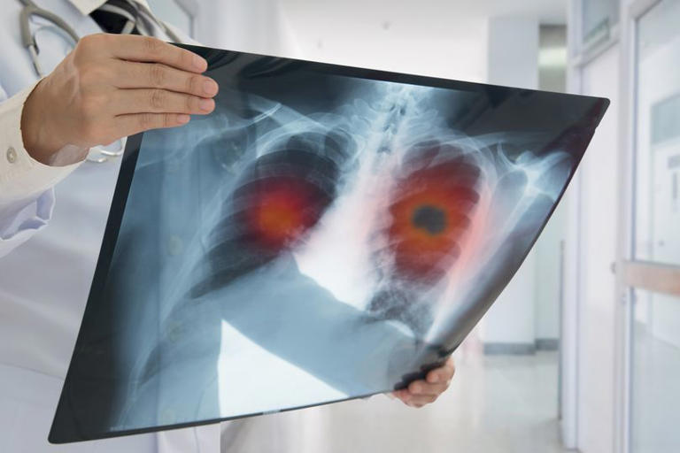 Urine test detecting early signs of lung cancer could be on NHS in ...