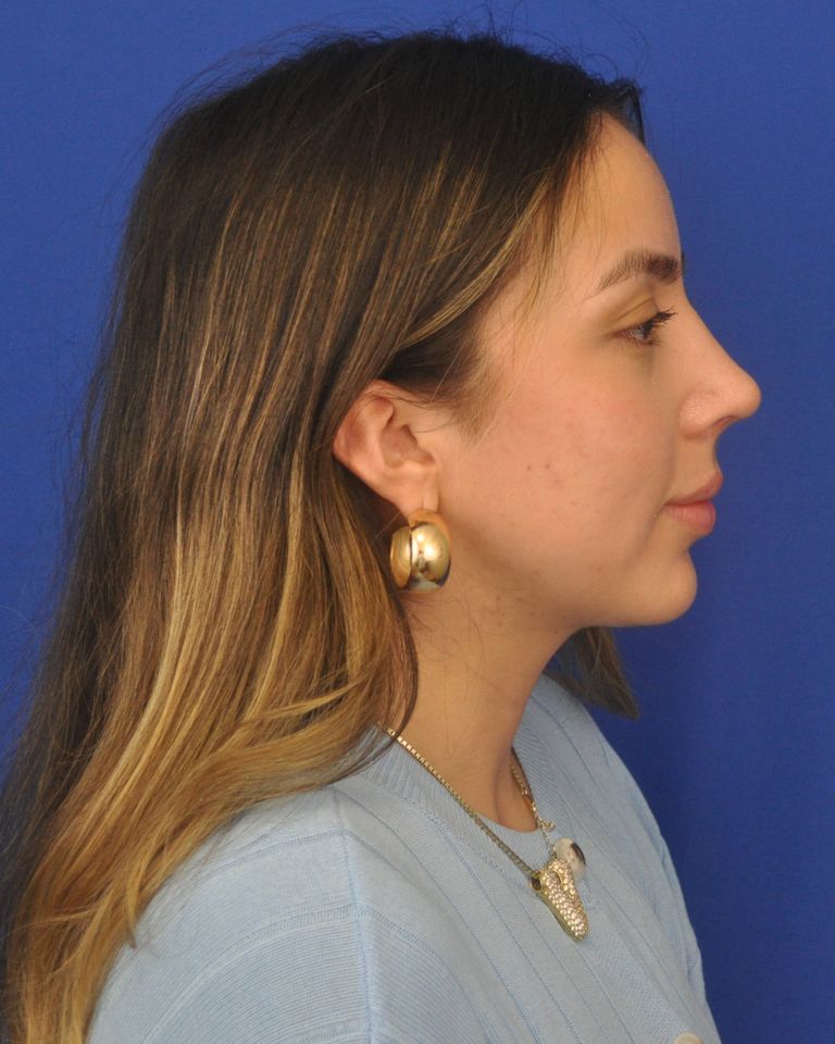 She wanted to get a nose job for 15 years. She was nearly speechless ...