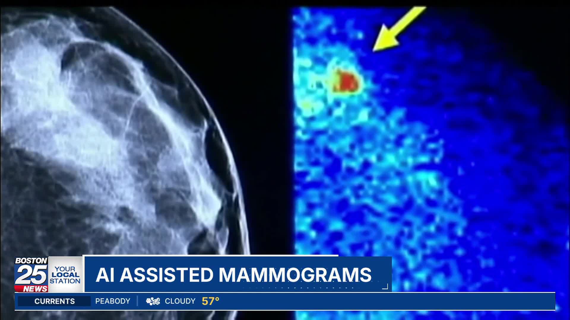 AI-powered mammograms may detect breast cancer early, new study finds